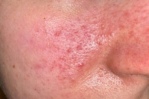 Dr. Martha Humer – Hautärztin